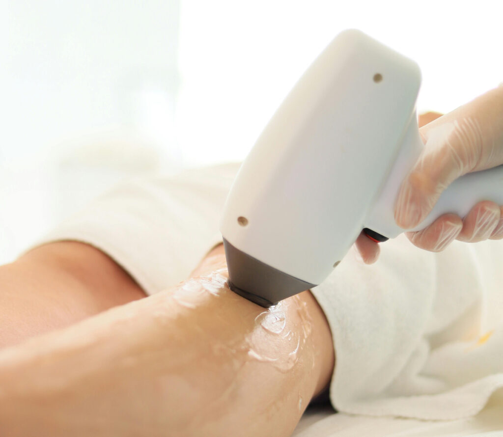 Épilation laser : pourquoi y recourir